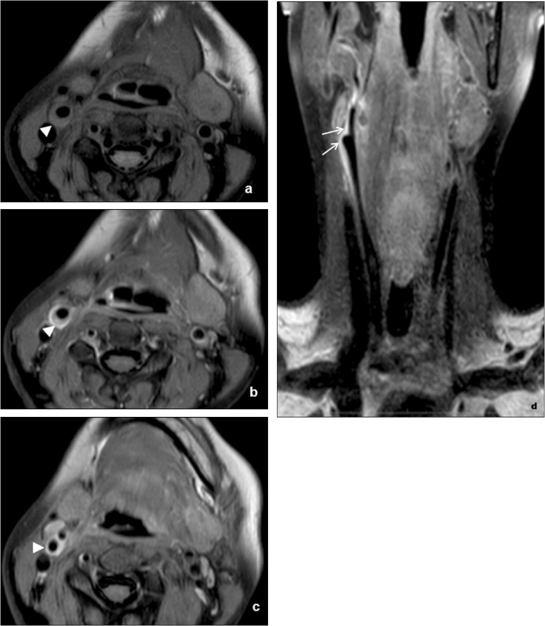 Role of Ultrasound in the Diagnosis and Follow-Up of Transient ...