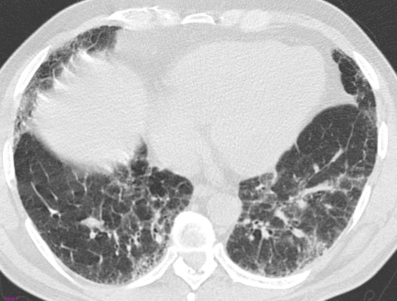 Highlights of HRCT imaging in IPF | Respiratory Research | Full Text
