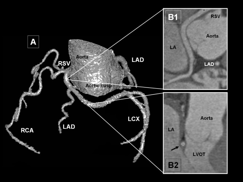 Visualization of anomalous origin and course of coronary arteries in ...