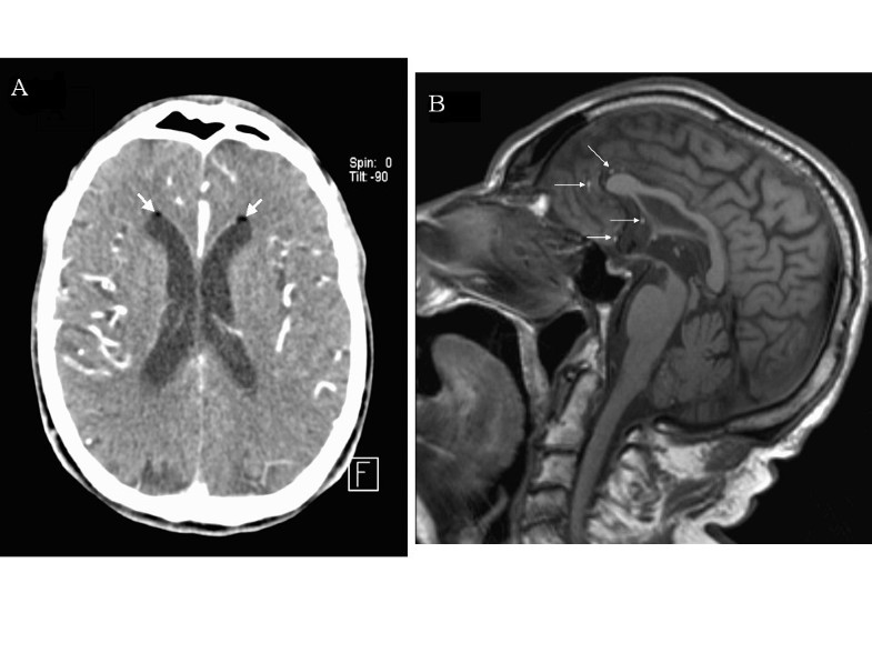 Confusion after spine injury: cerebral fat embolism after traumatic ...