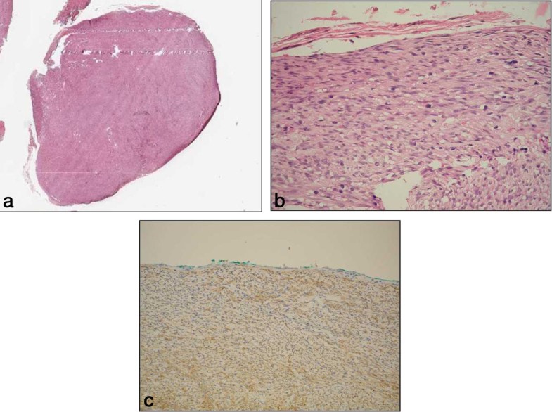Modified endoscopic submucosal dissection with enucleation for ...