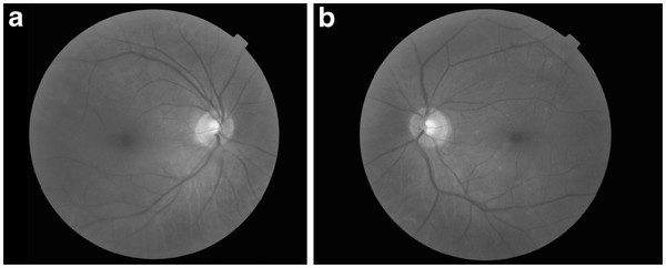Chancre of the eyelid as manifestation of primary syphilis, and ...