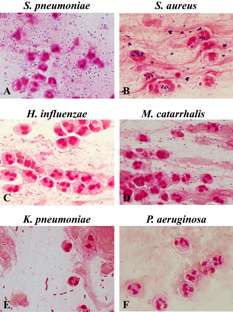 Validation of sputum Gram stain for treatment of community-acquired ...