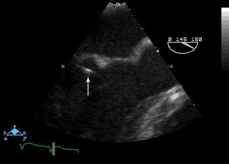 Streptococcus intermedius causing infective endocarditis and abscesses ...