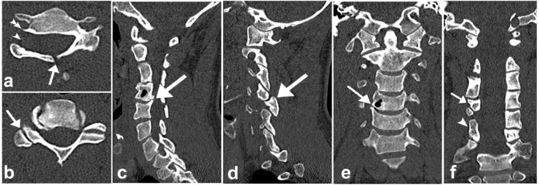 Absent Cervical Spine Pedicle And Associated Congenital Spinal