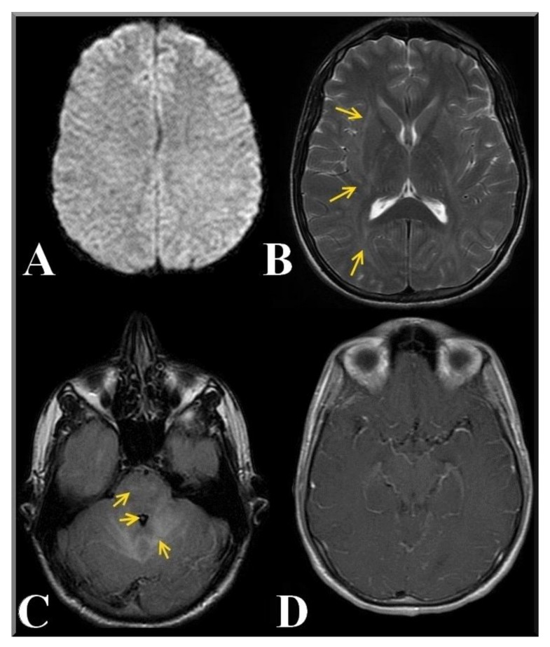 Unusual MRI findings in an immunocompetent patient with EBV ...