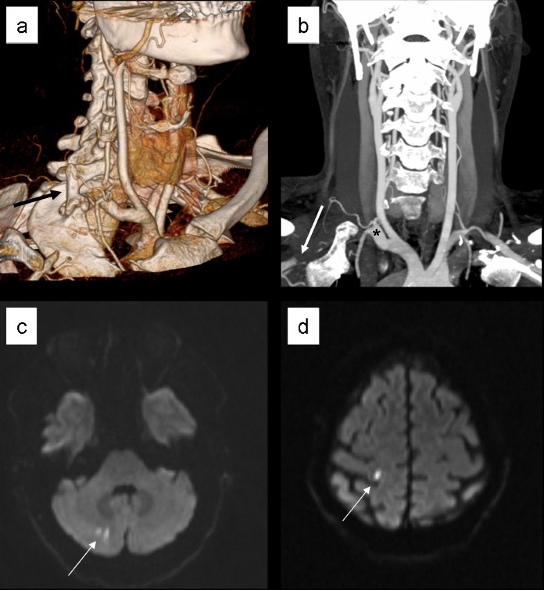 An unusual case of the syndrome of cervical rib with subclavian artery ...