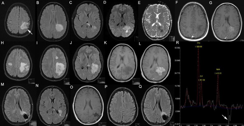 A rare presentation of atypical demyelination: tumefactive multiple ...