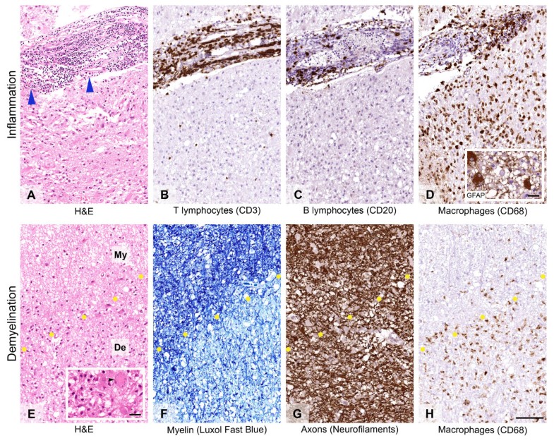 A rare presentation of atypical demyelination: tumefactive multiple ...