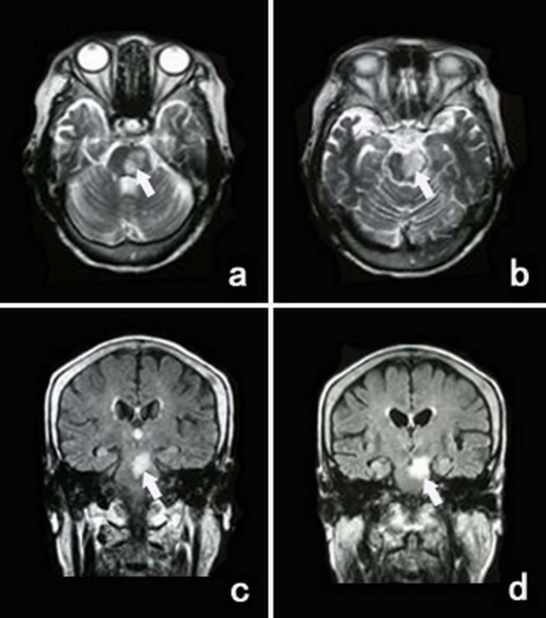Pontine infarction with pure motor hemiparesis or hemiplegia: A ...