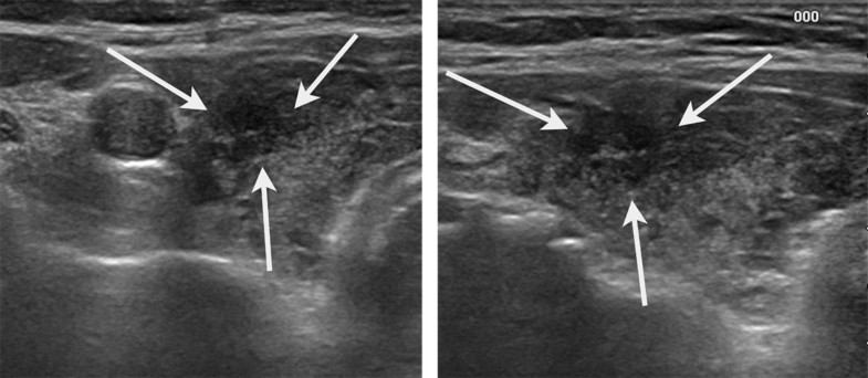Heterogeneous echogenicity of the underlying thyroid parenchyma: how ...