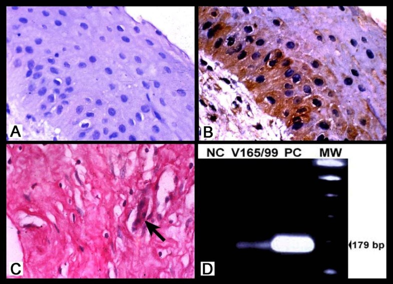 Atypical Herpes simplex keratitis (HSK) presenting as a perforated ...