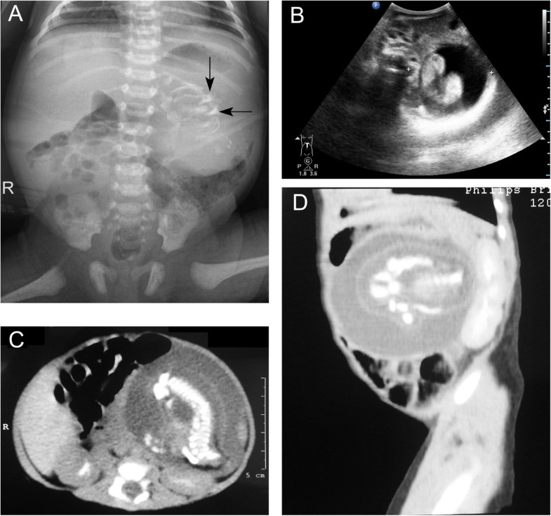 Fetus in fetu: two case reports and literature review | SpringerLink