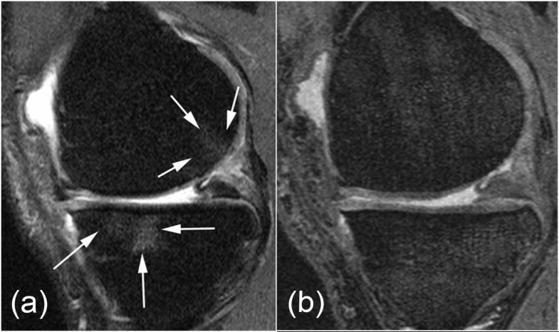 Semiquantitative assessment of subchondral bone marrow edema-like lesions and subchondral cysts ...