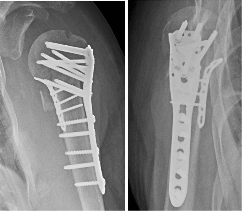 Clinical investigation for displaced proximal humeral fractures in the ...