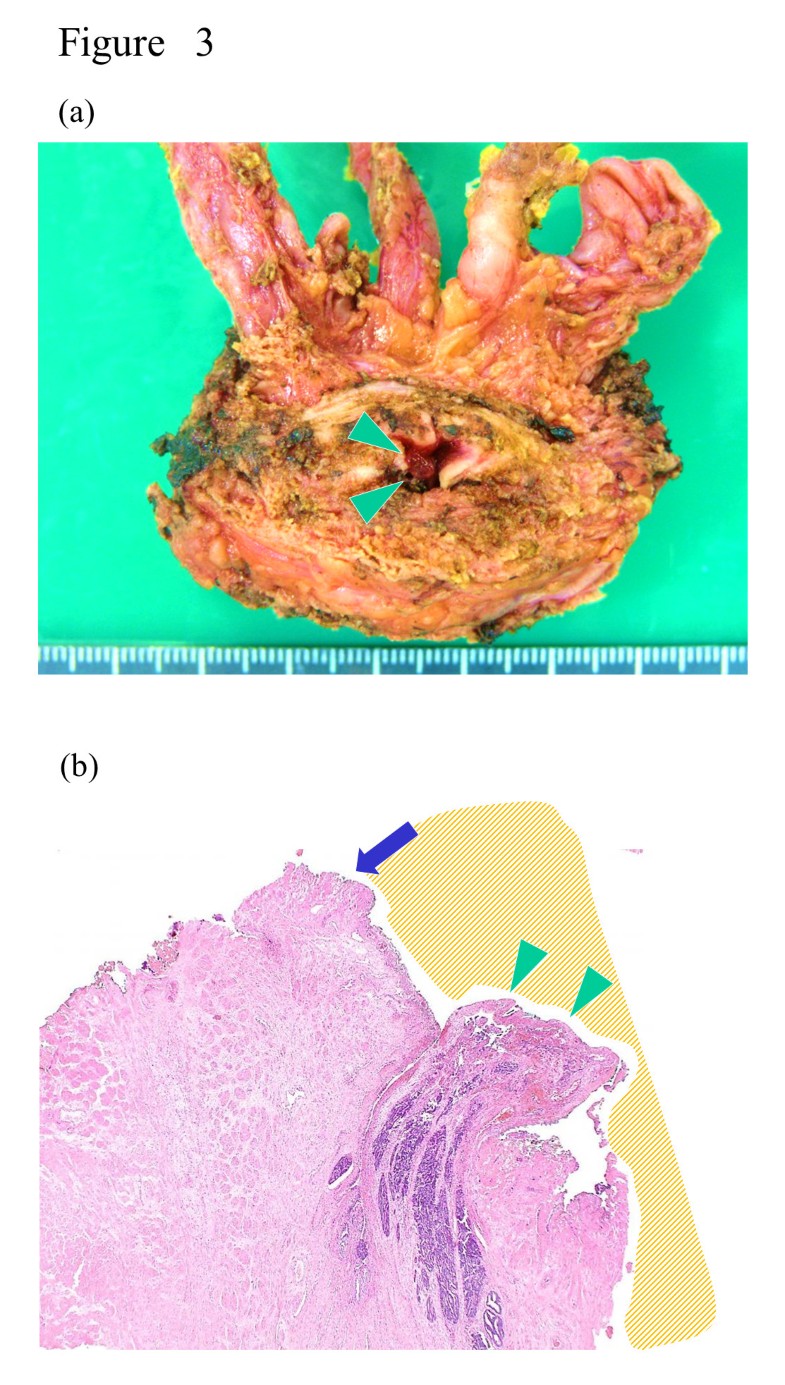 Transurethral marking incision of the bladder neck: a helpful technique ...
