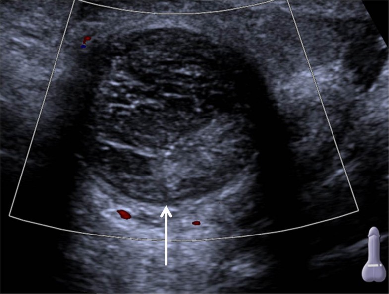 Partial Segmental Thrombosis of the Corpus Cavernosum (PSTCC) diagnosed ...