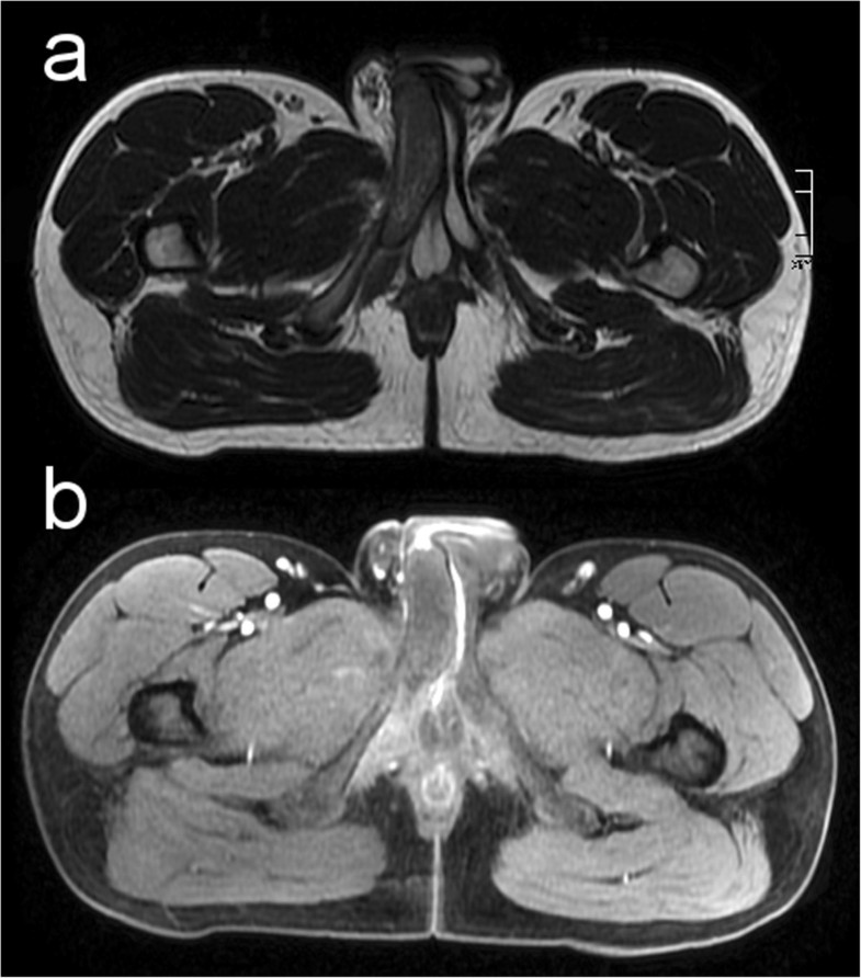 Partial Segmental Thrombosis of the Corpus Cavernosum (PSTCC) diagnosed ...