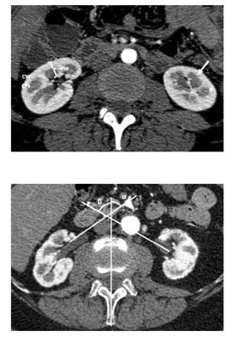 Normal kidney size and its influencing factors - a 64-slice MDCT study ...