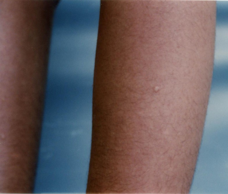 An unusual presentation of anetoderma: a case report | BMC Dermatology ...