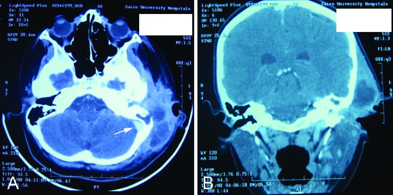 Acute mastoiditis: A one year study in the pediatric hospital of Cairo ...