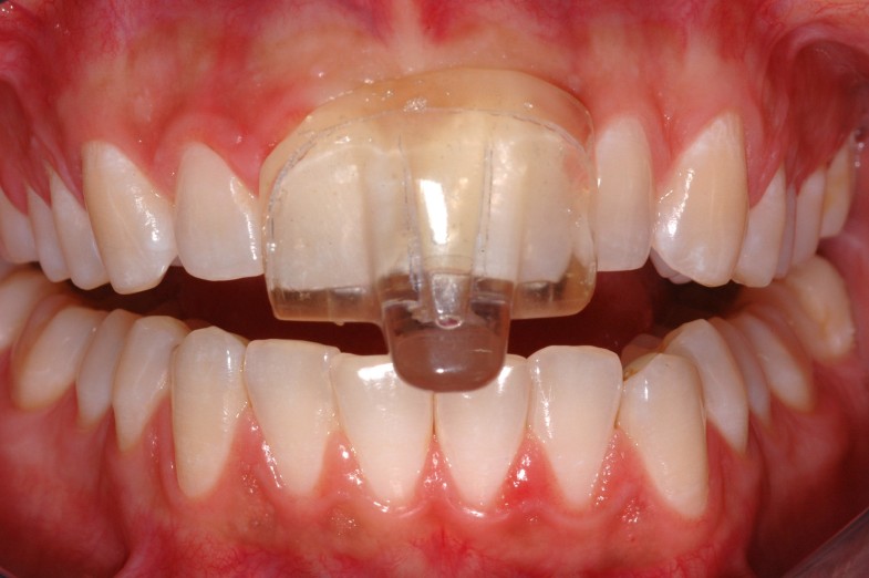 The NTI-tss device for the therapy of bruxism, temporomandibular ...