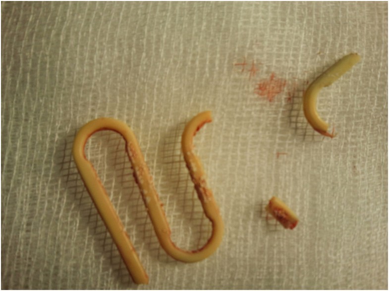 Lippes Loop intrauterine device left in the uterus for 50 years: case ...