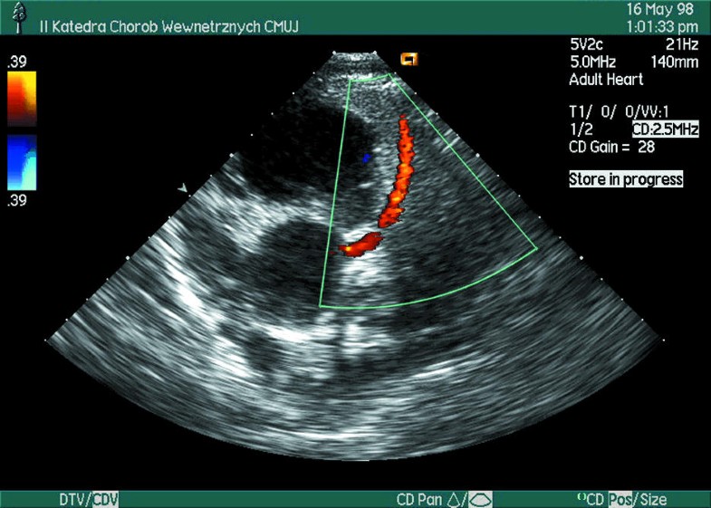 Transthoracic Doppler echocardiography – noninvasive diagnostic window ...