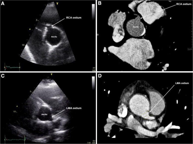 A novel parasternal transthoracic echocardiographic window for ...