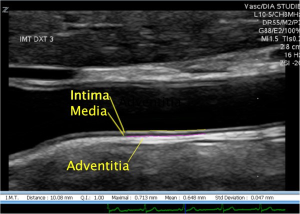 Measurements Of Carotid Intima Media Thickness In Non Invasive High