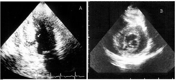 Subacute left ventricle free wall rupture after acute myocardial ...