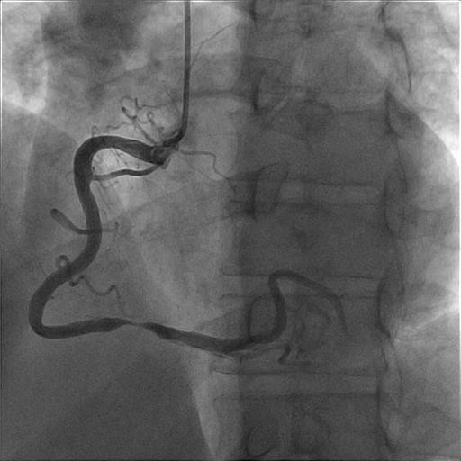 Direct visualization of a significant stenosis of the right coronary ...
