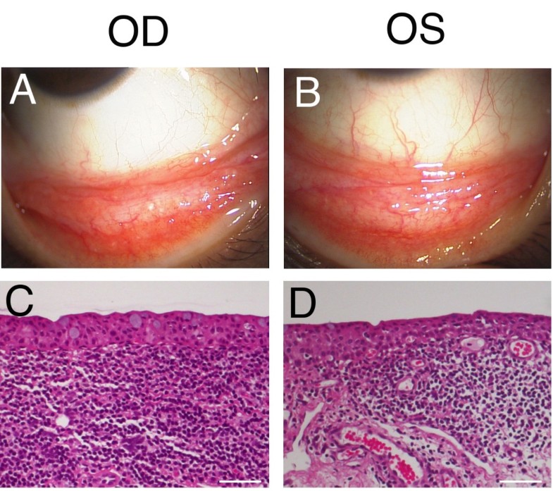Conjunctival lymphoma arising from reactive lymphoid hyperplasia ...