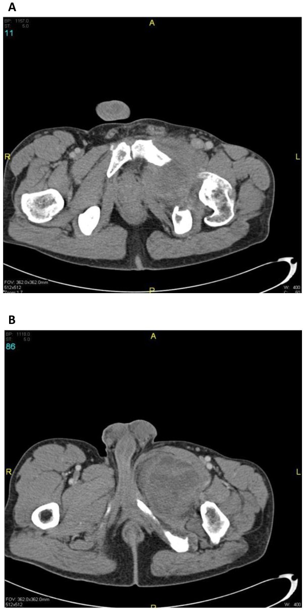 En bloc resection of extra-peritoneal soft tissue neoplasms ...