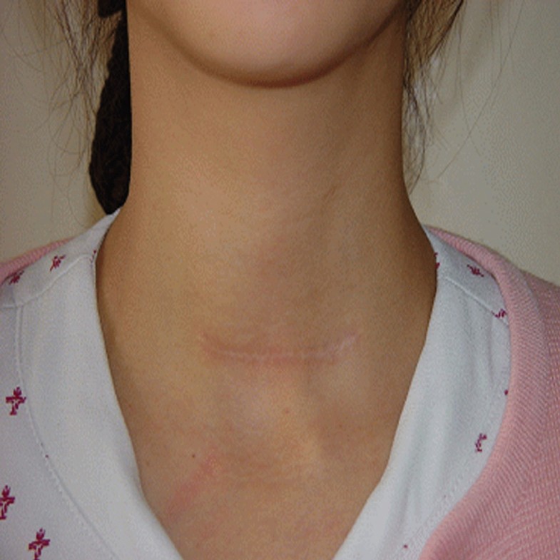 Comparative study comparing endoscopic thyroidectomy using the axillary ...