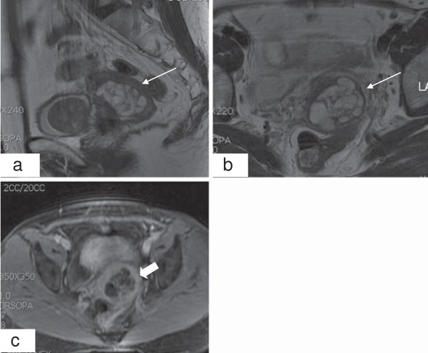 Adenoma Malignum Of The Uterine Cervix Report Of Four Cases World