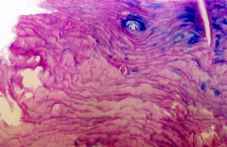 Cutaneous horns: are these lesions as innocent as they seem to be ...