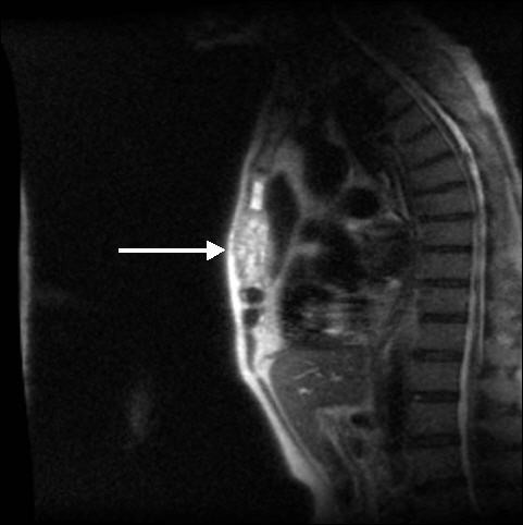 Mucinous adenocarcinoma presenting as an isolated sternal metastasis ...
