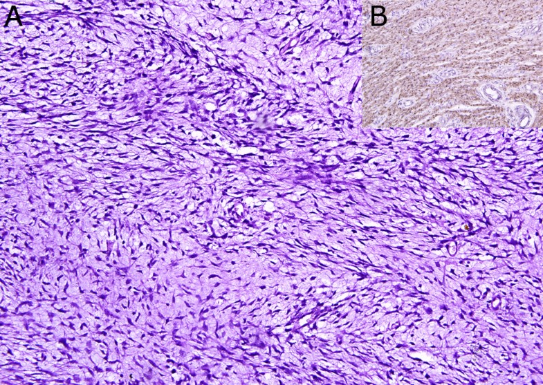 Malignant peripheral nerve sheath tumor of the breast: case report ...