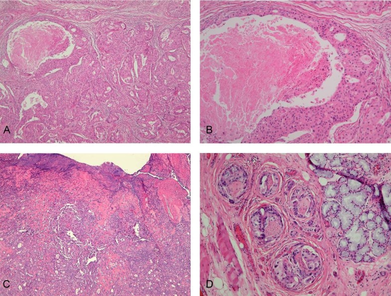 Carcinoma ex pleomorphic adenoma of soft palate with cavernous sinus ...