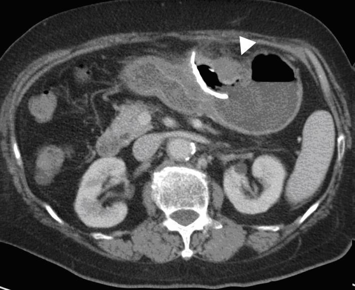 Thick calcification from a GIST of the stomach penetrating into ...