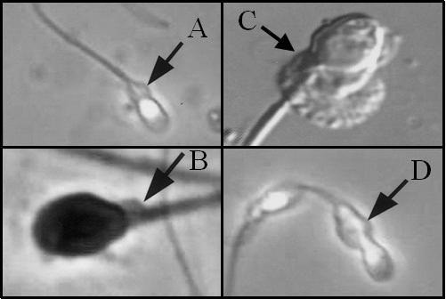An investigation of excess residual cytoplasm in human spermatozoa and ...