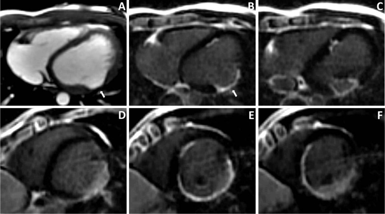 Cardiac injuries in blunt chest trauma | Journal of Cardiovascular ...