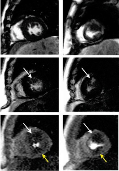 Abnormal myocardial perfusion in hypertrophic cardiomyopathy ...