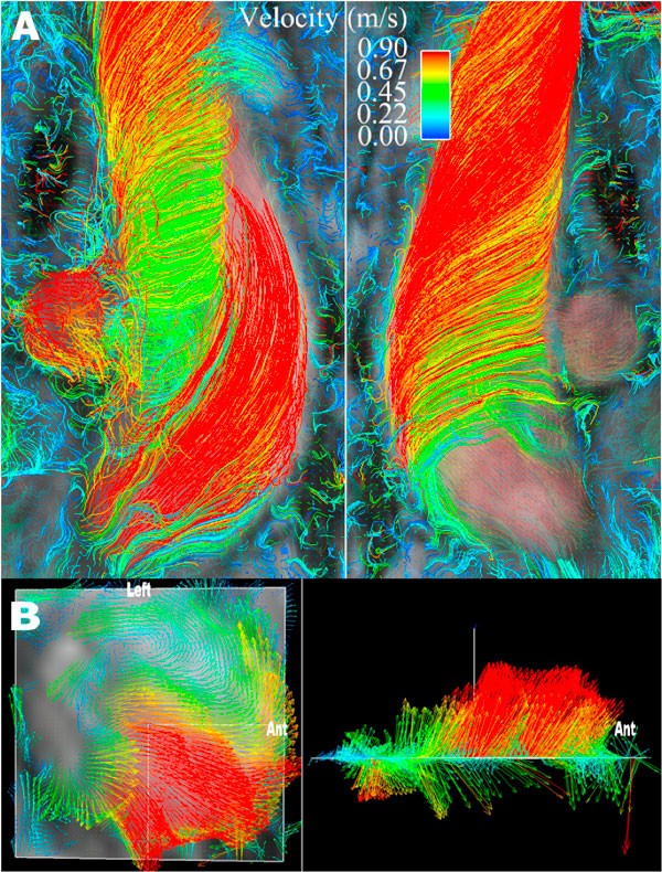 Eccentric flow jets and elevated wall shear stress with bicuspid aortic ...