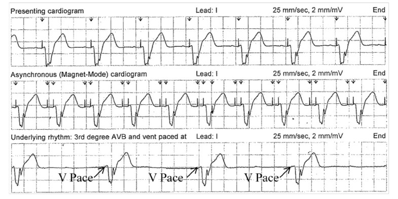 Magnetic resonance imaging in patients with cardiac pacemakers: era of ...