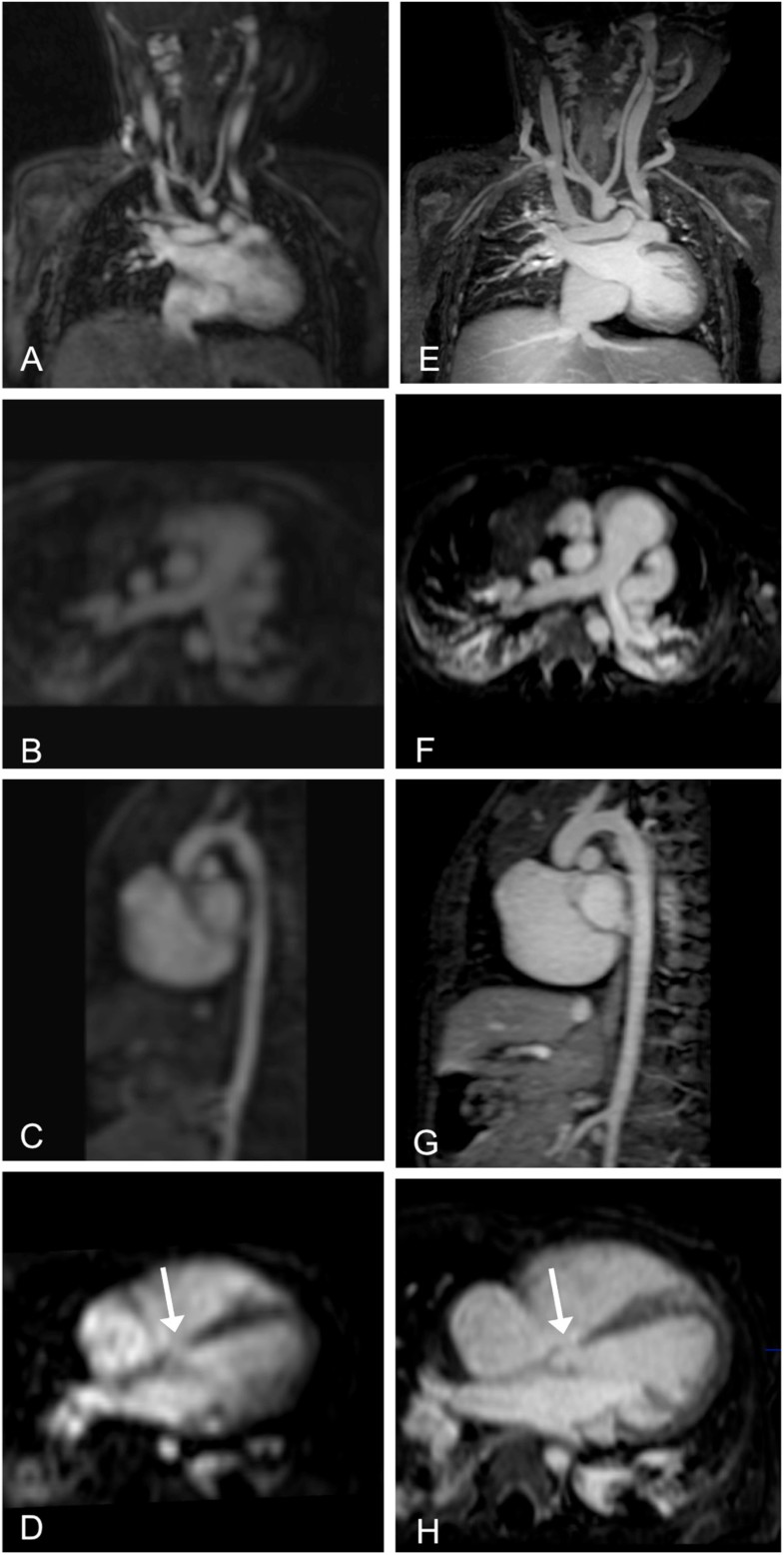 High-resolution motion compensated MRA in patients with congenital ...
