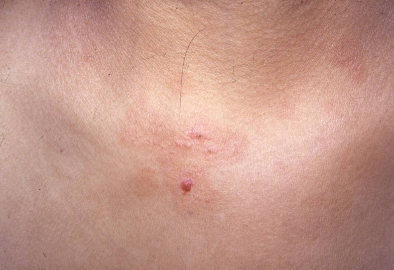 Bullous lesions as a manifestation of systemic lupus erythematosus in ...