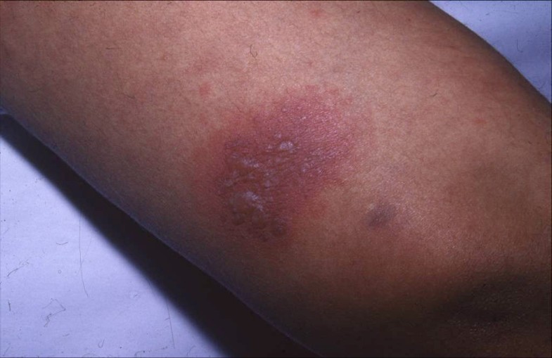 Bullous lesions as a manifestation of systemic lupus erythematosus in ...