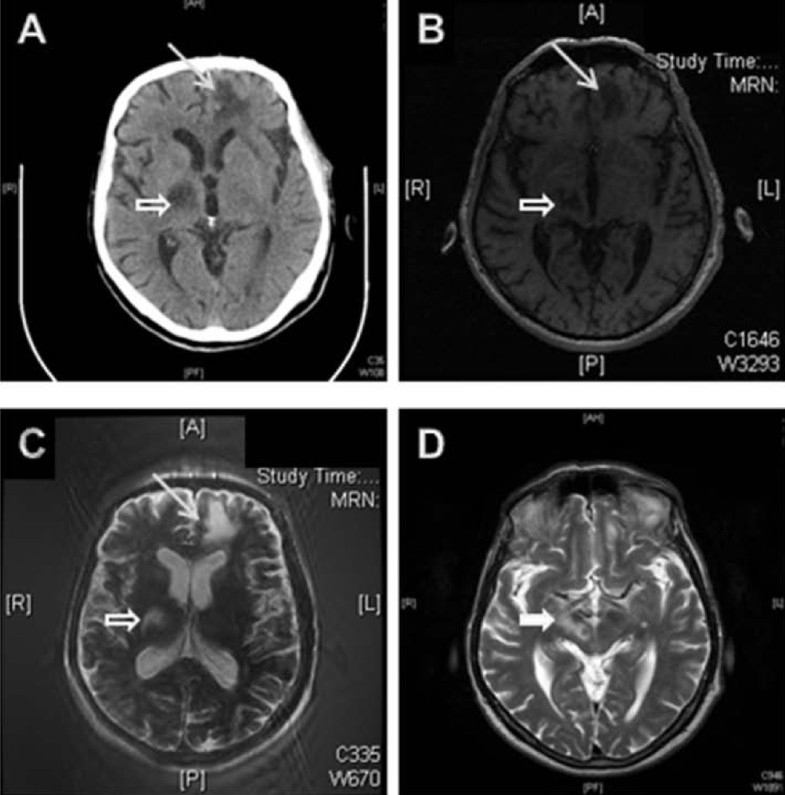 Progressive multifocal leukoencephalopathy in a patient without ...